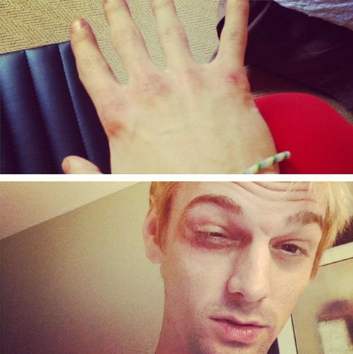 OMG gossip: Who blackened Aaron Carter's pretty eye? - OMG.BLOG